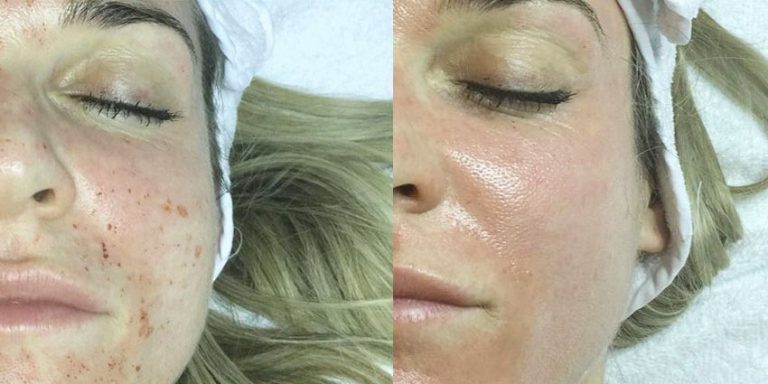 Does LED Light Therapy Work? [The Truth About LED Face Masks] | LED ...
